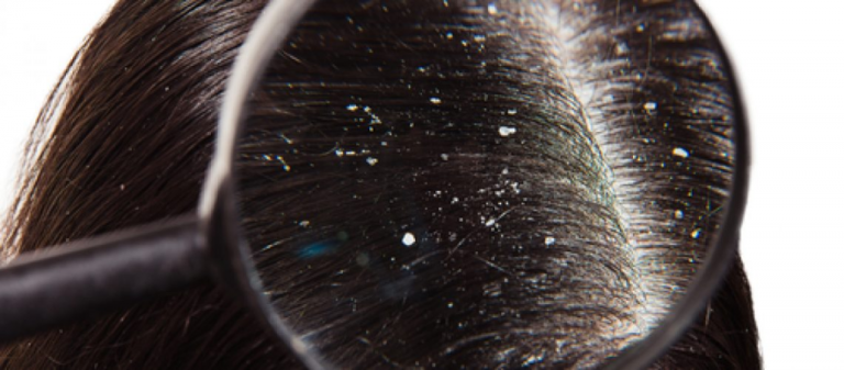 Dermatite Seborreica - Dermatologia