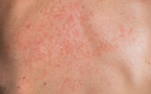 Pitiríase rósea - Dermatologia