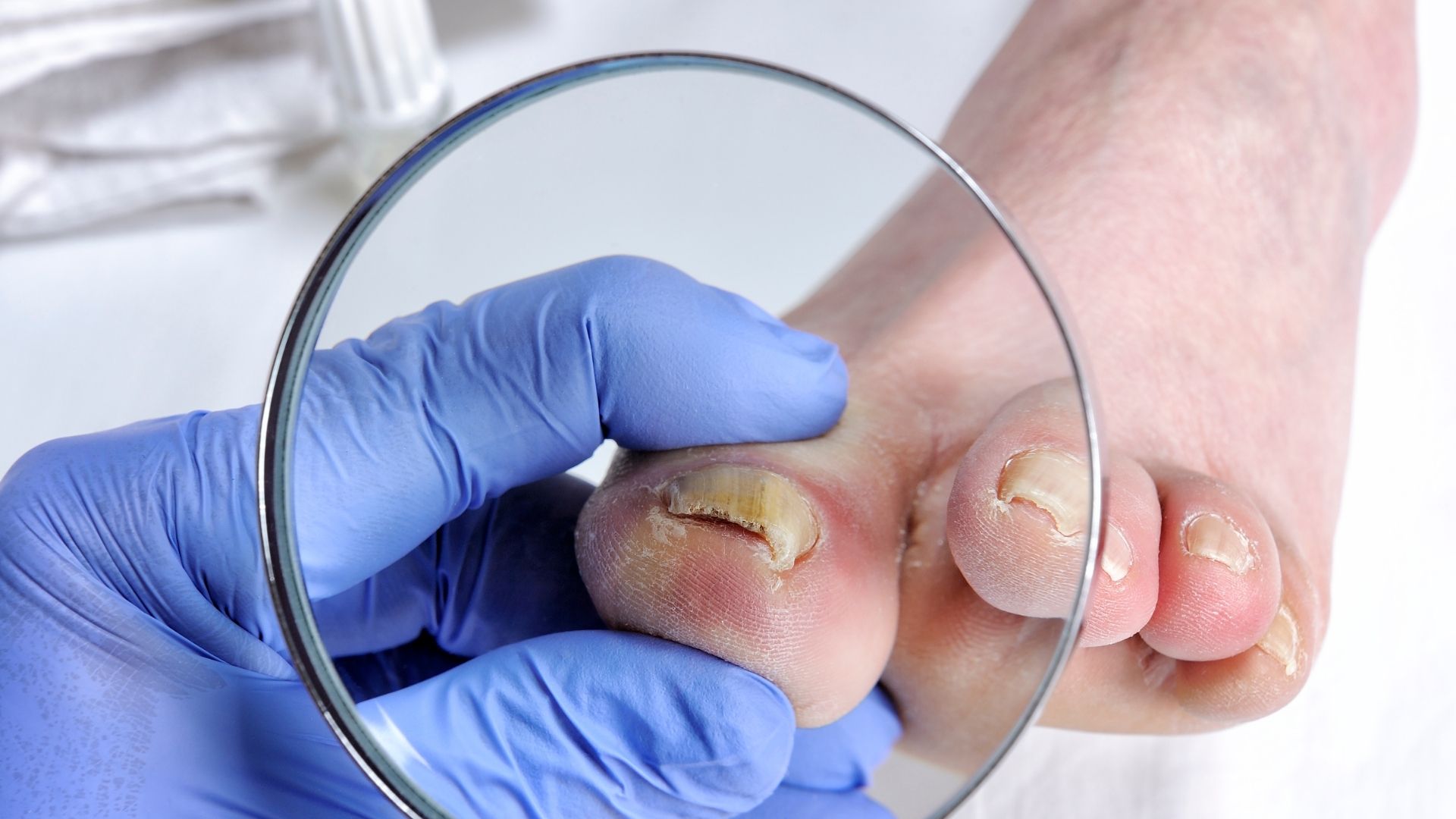 Laser para onicomicose: Conheça o tratamento - Dermatologia